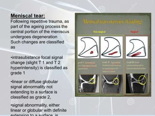 Radiological anatomy of Knee joint.pptx