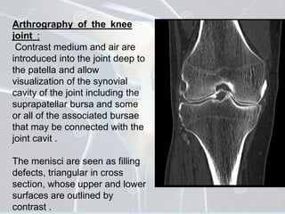 Radiological anatomy of Knee joint.pptx