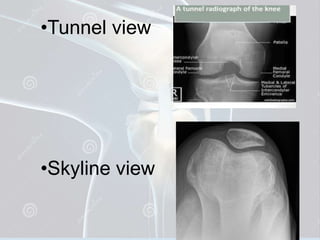 Radiological anatomy of Knee joint.pptx
