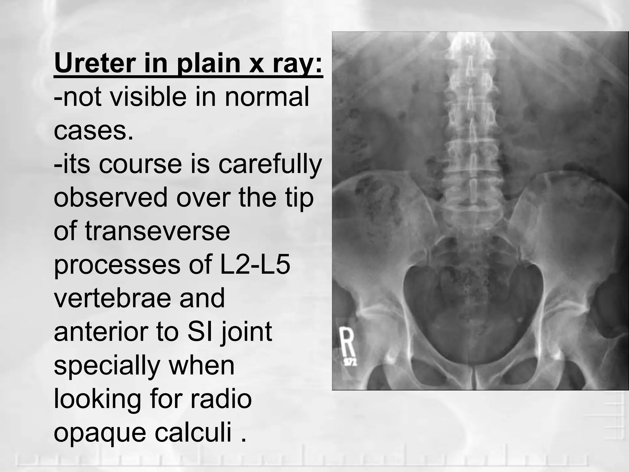 Radiological Anatomy of Kidney, uteter and urinary bladder.pptx | PPTX