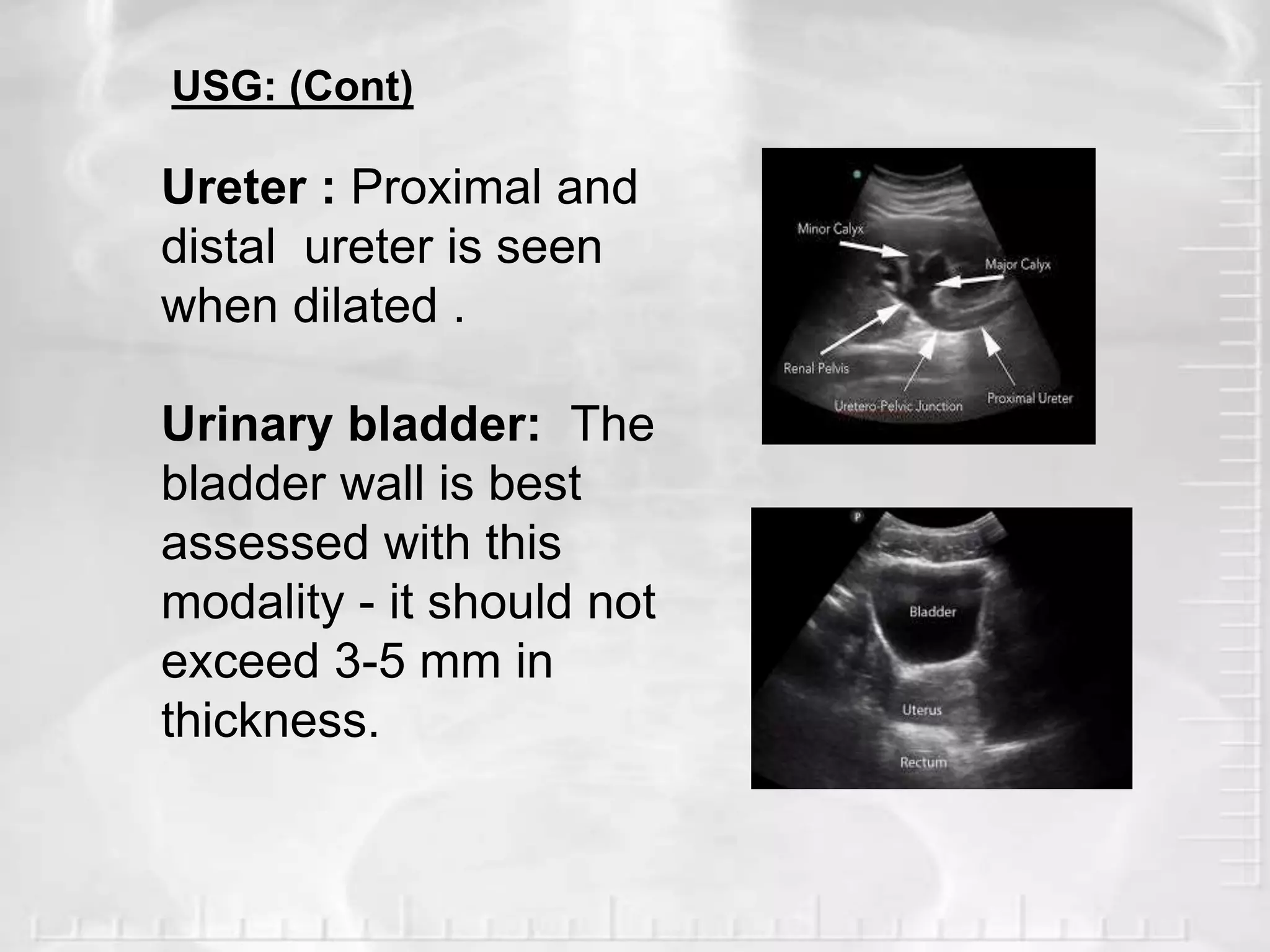 Radiological Anatomy of Kidney, uteter and urinary bladder.pptx | PPTX