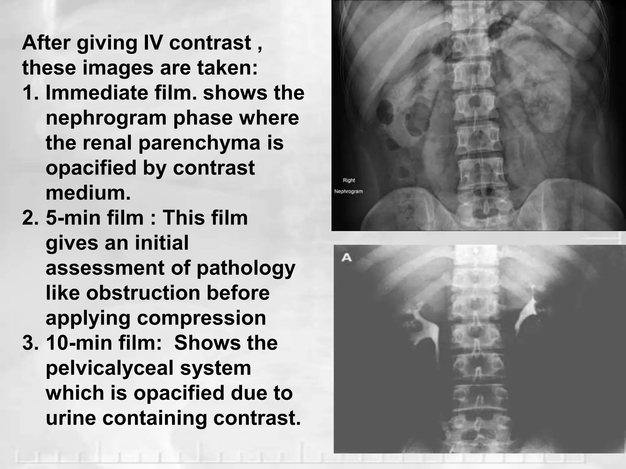 Radiological Anatomy of Kidney, uteter and urinary bladder.pptx | PPTX