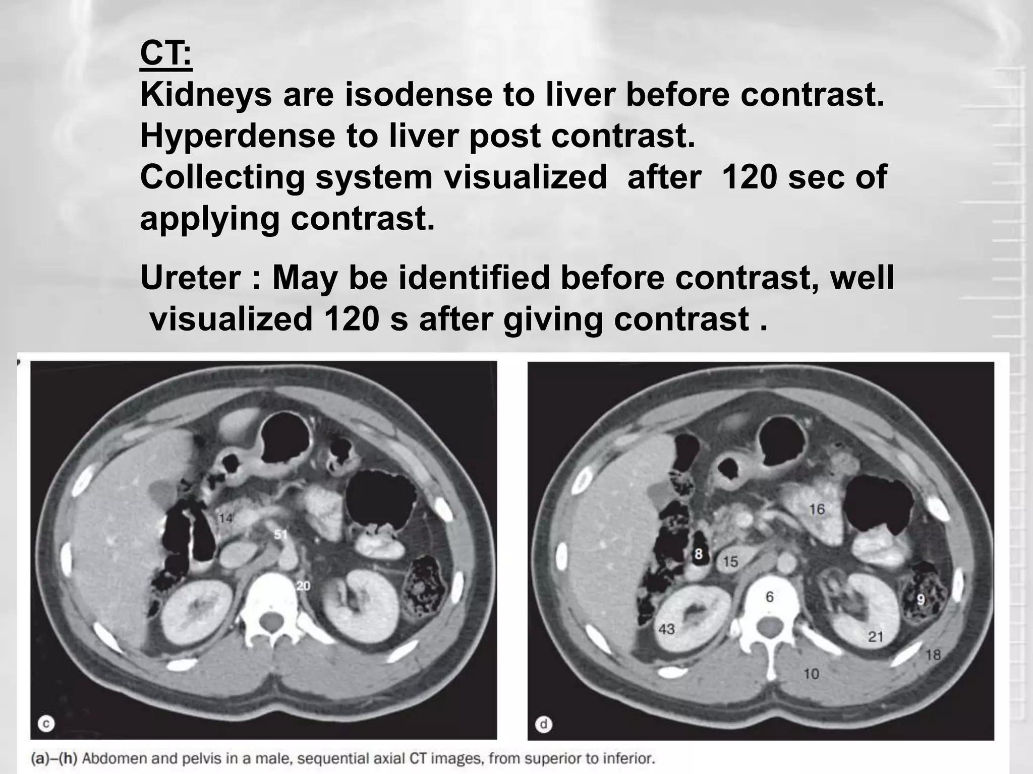 Radiological Anatomy of Kidney, uteter and urinary bladder.pptx | PPTX