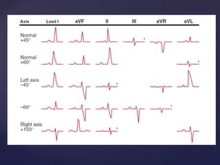 Rapid interpretation of ECG | PPT