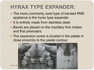 Rapid maxillary expansion in orthodontics | PPTX