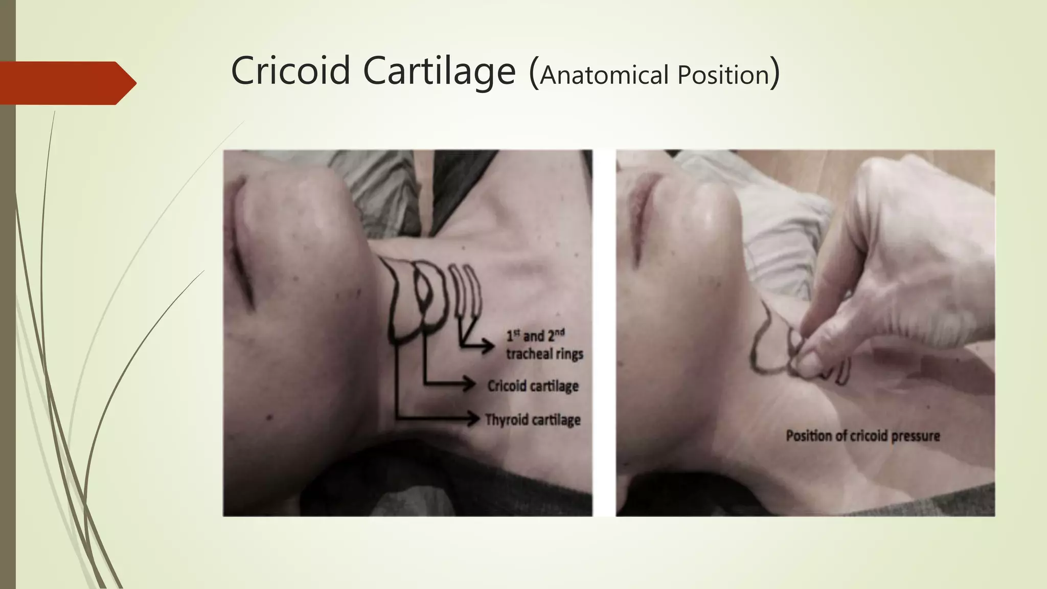 Rapid sequence intubation | PPTX