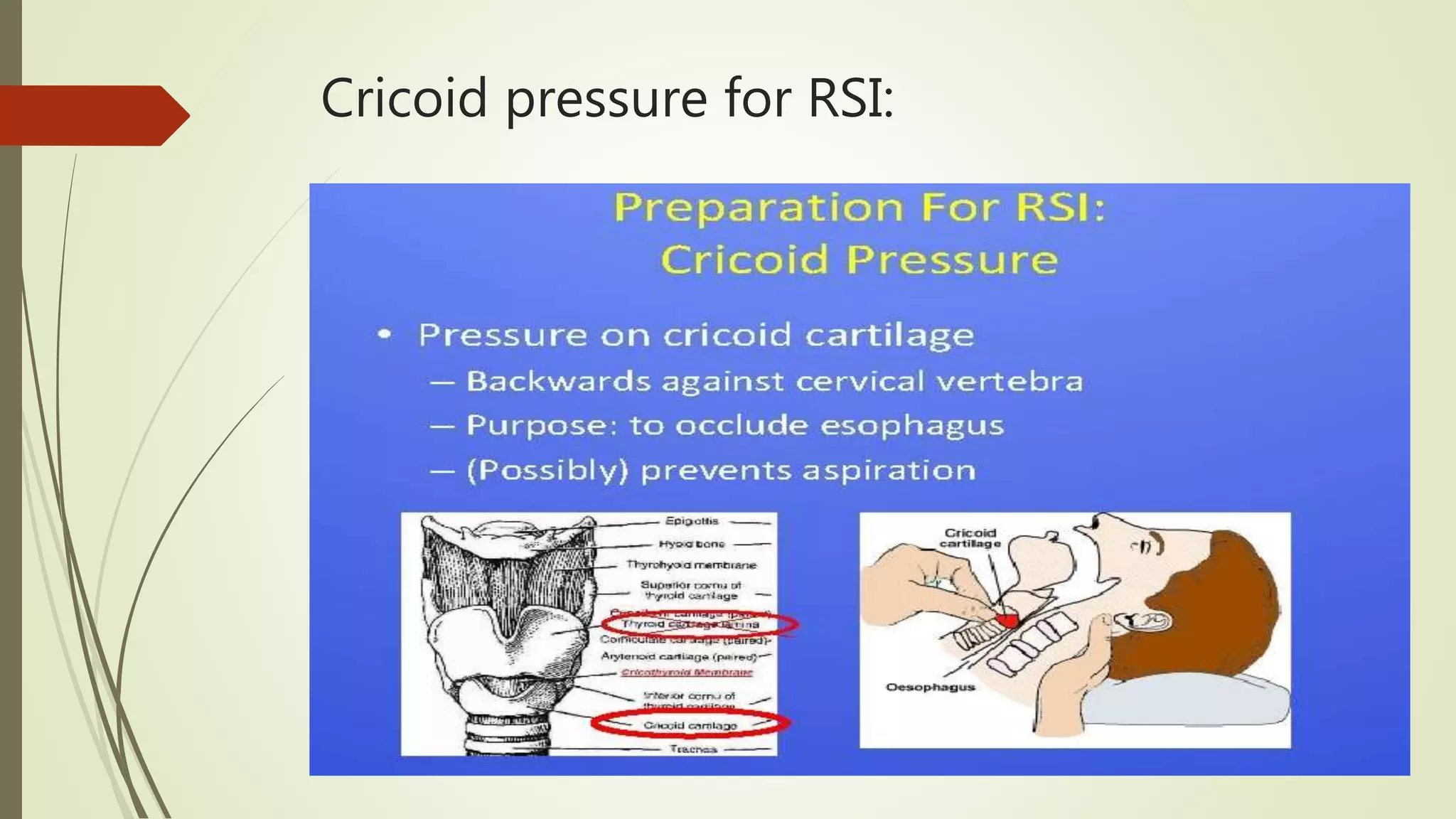 Rapid sequence intubation | PPTX