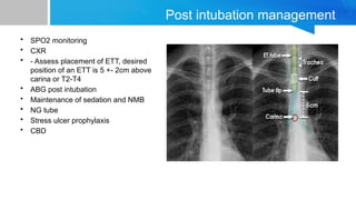 Rapid Sequence Intubation.pptxghhhghgggh | PPTX