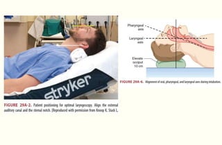 Rapid sequence intubation in ED | PPTX | First Aid | Injuries
