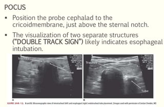 Rapid sequence intubation in ED | PPTX | First Aid | Injuries