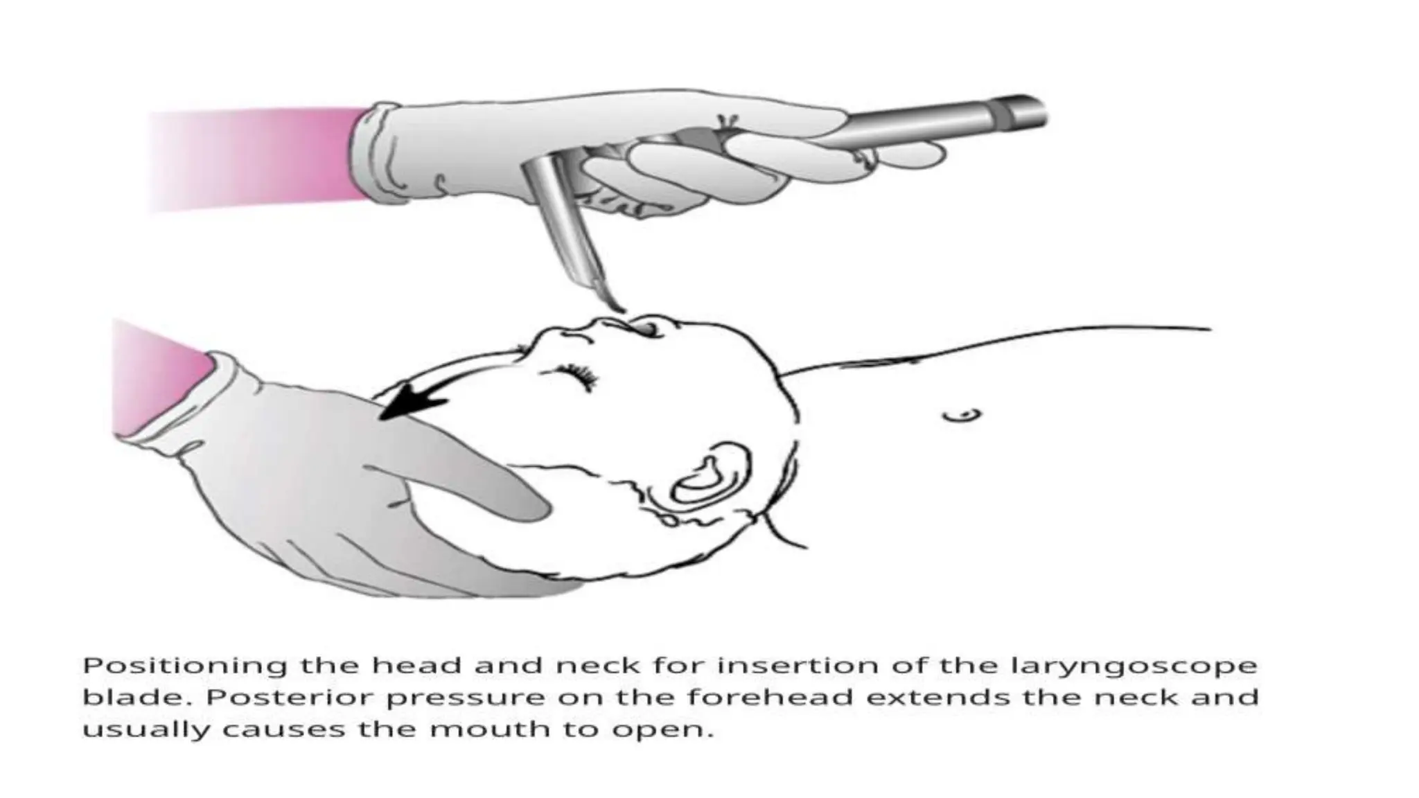 Rapid Sequence Intubation (RSI).pptx
