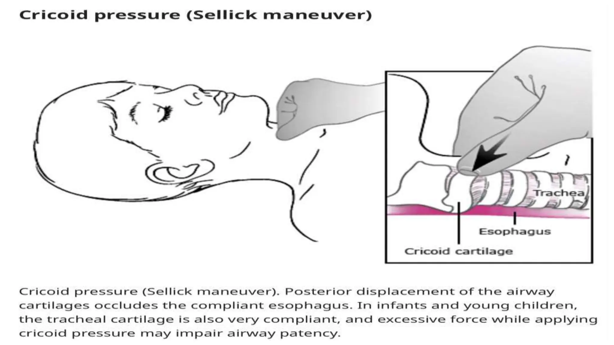Rapid Sequence Intubation (RSI).pptx