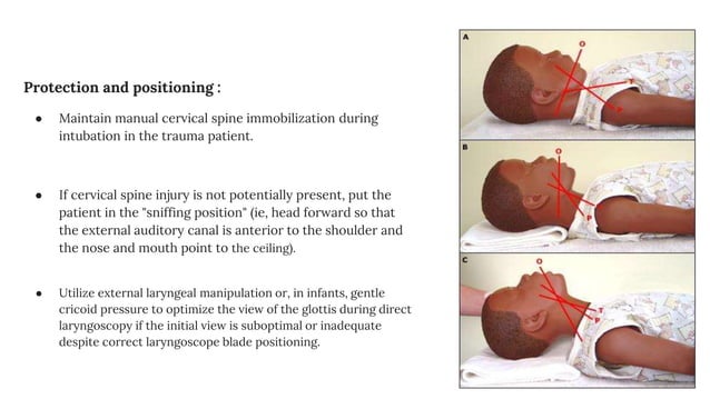 Rapid Sequence Intubation (RSI).pptx
