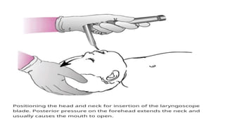 Rapid Sequence Intubation (RSI).pptx