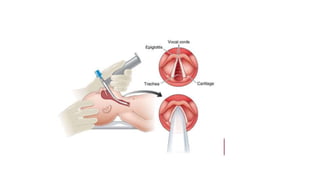 Rapid Sequence Intubation (RSI).pptx