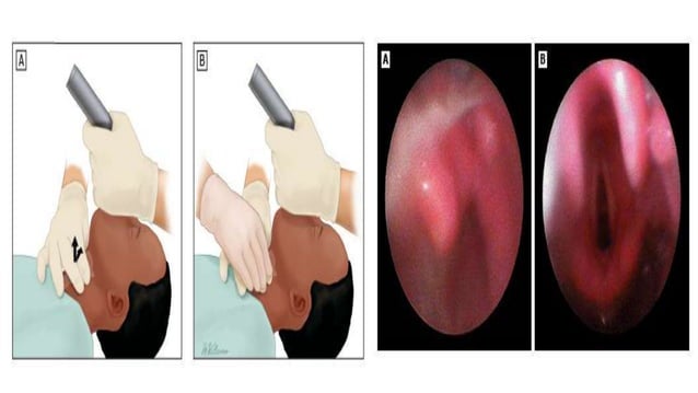 Rapid Sequence Intubation (RSI).pptx