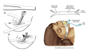 Rapid Sequence Intubation (RSI).pptx