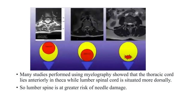 Rapid sequence spinal anesthesia (RSS).pptx | Lung and Respiratory ...