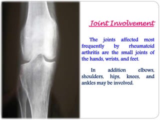 RHEUMATOID ARTHRITIS | PPTX