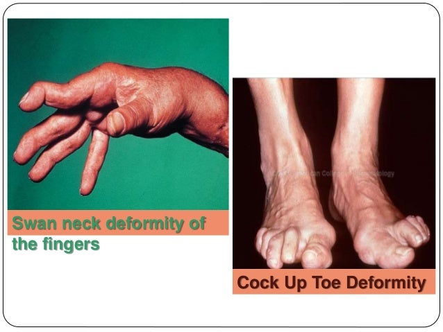RHEUMATOID ARTHRITIS