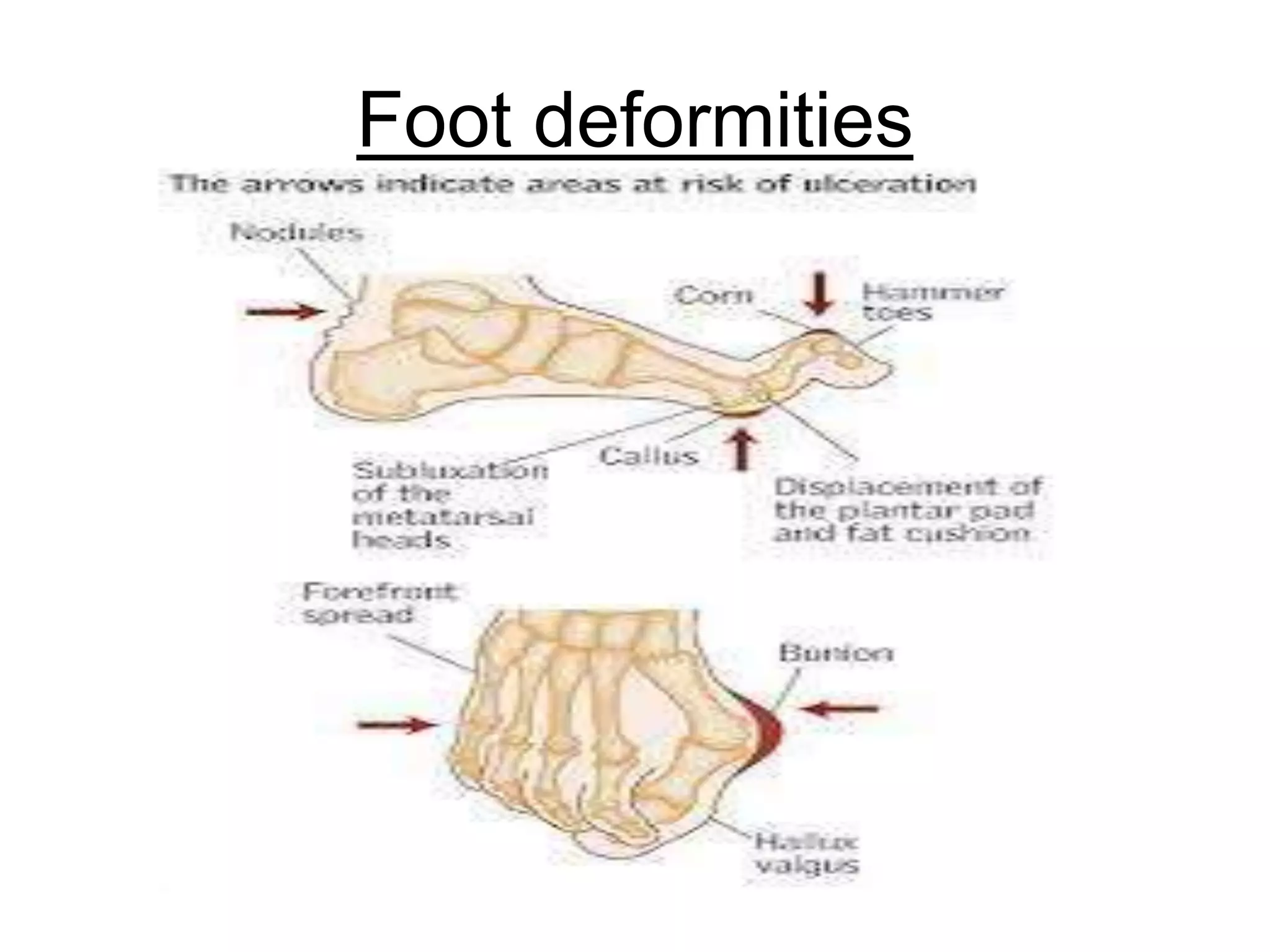 Rheumatoid arthritis | PPTX | Bone and Joint Conditions | Diseases and ...