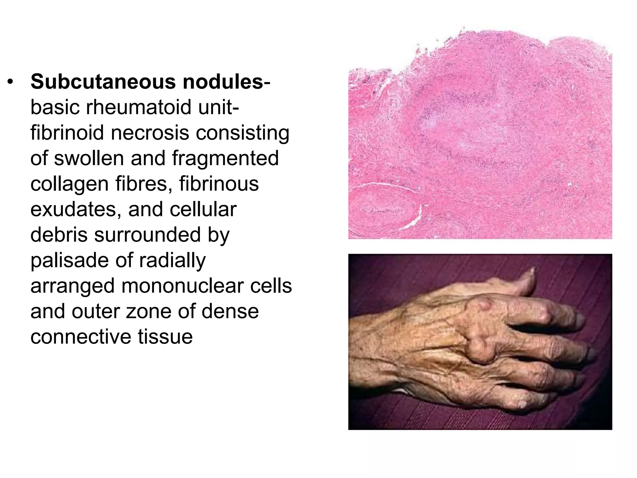 Rheumatoid arthritis | PPTX | Bone and Joint Conditions | Diseases and ...