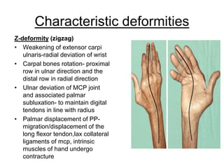 Z Line Deformity