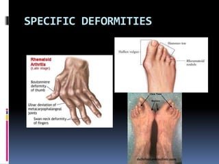 Rheumatoid Arthritis (Hudar) | PPT