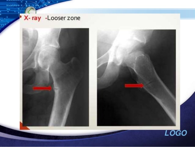 Raquitismo y osteomalacia