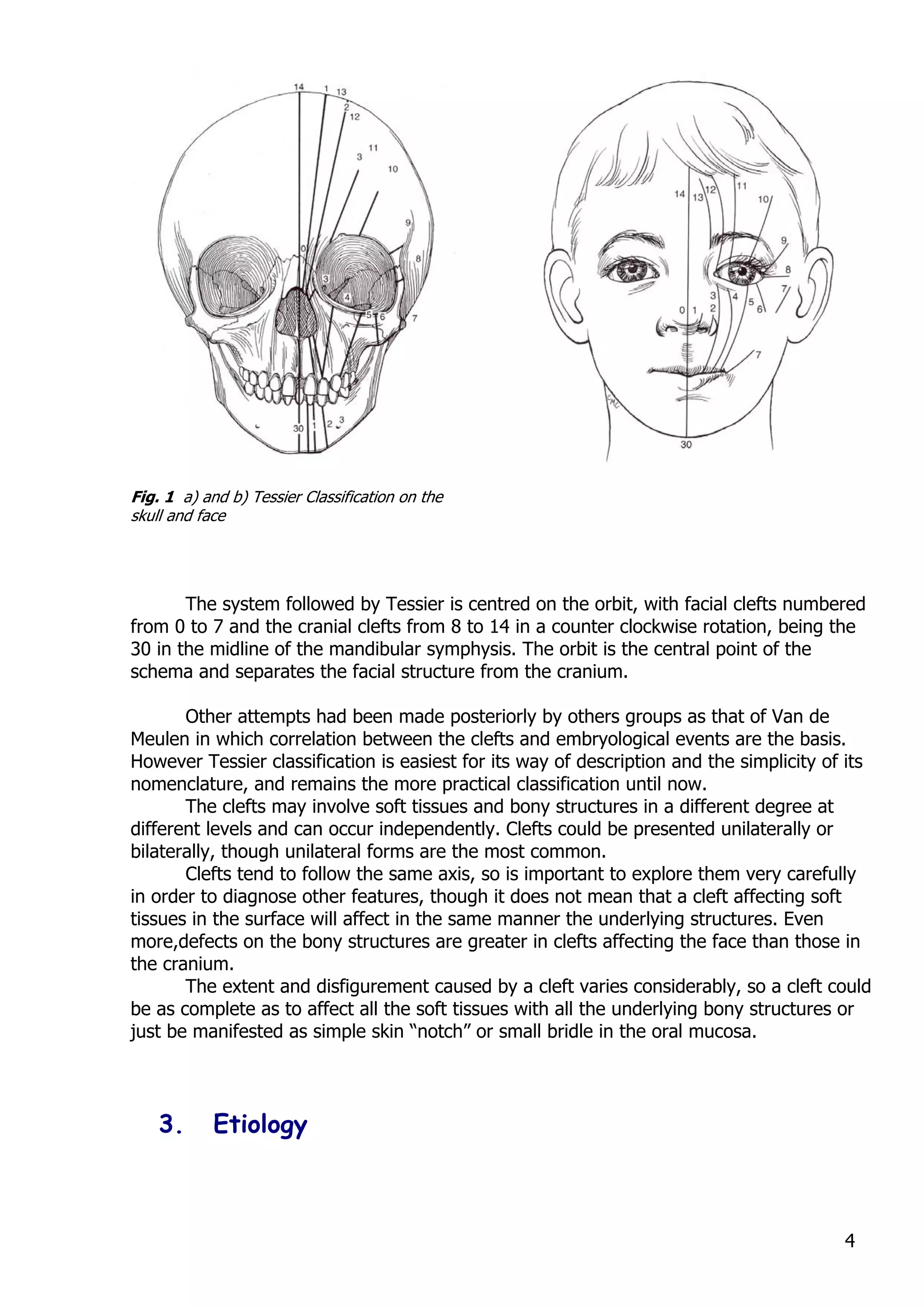 Fissuras de Tessier | PDF