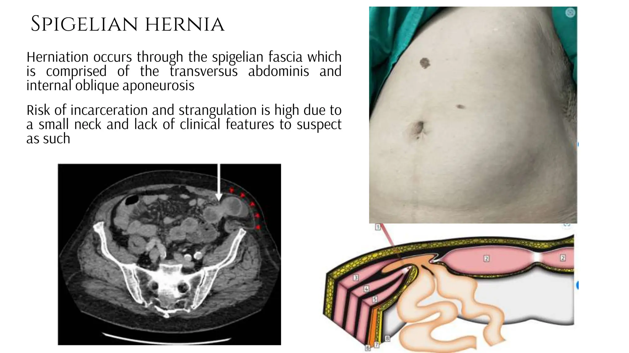 Rare Presentations of Hernias - Medical | PPTX