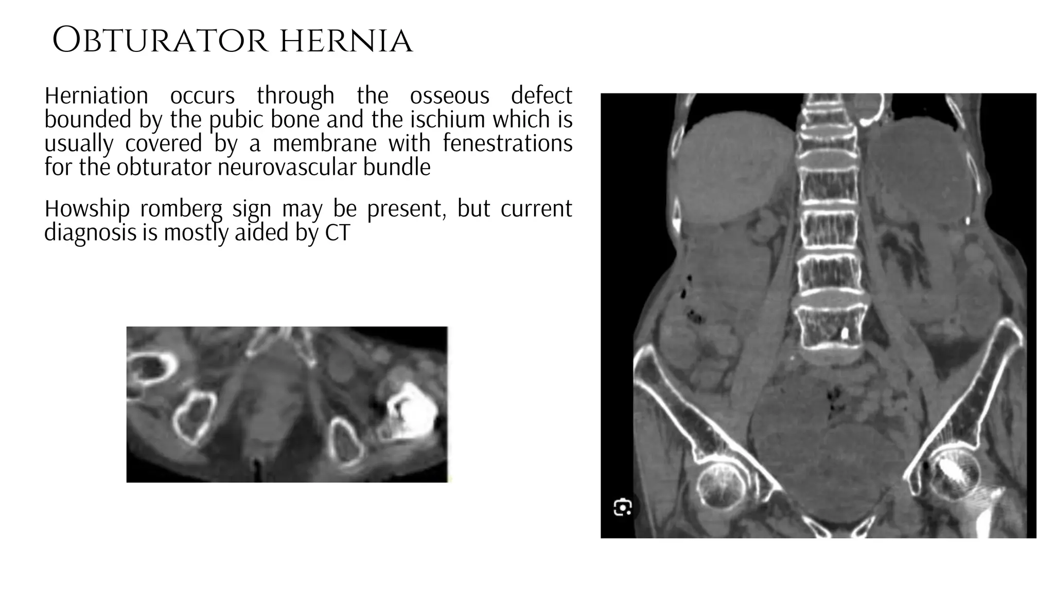 Rare Presentations of Hernias - Medical | PPTX