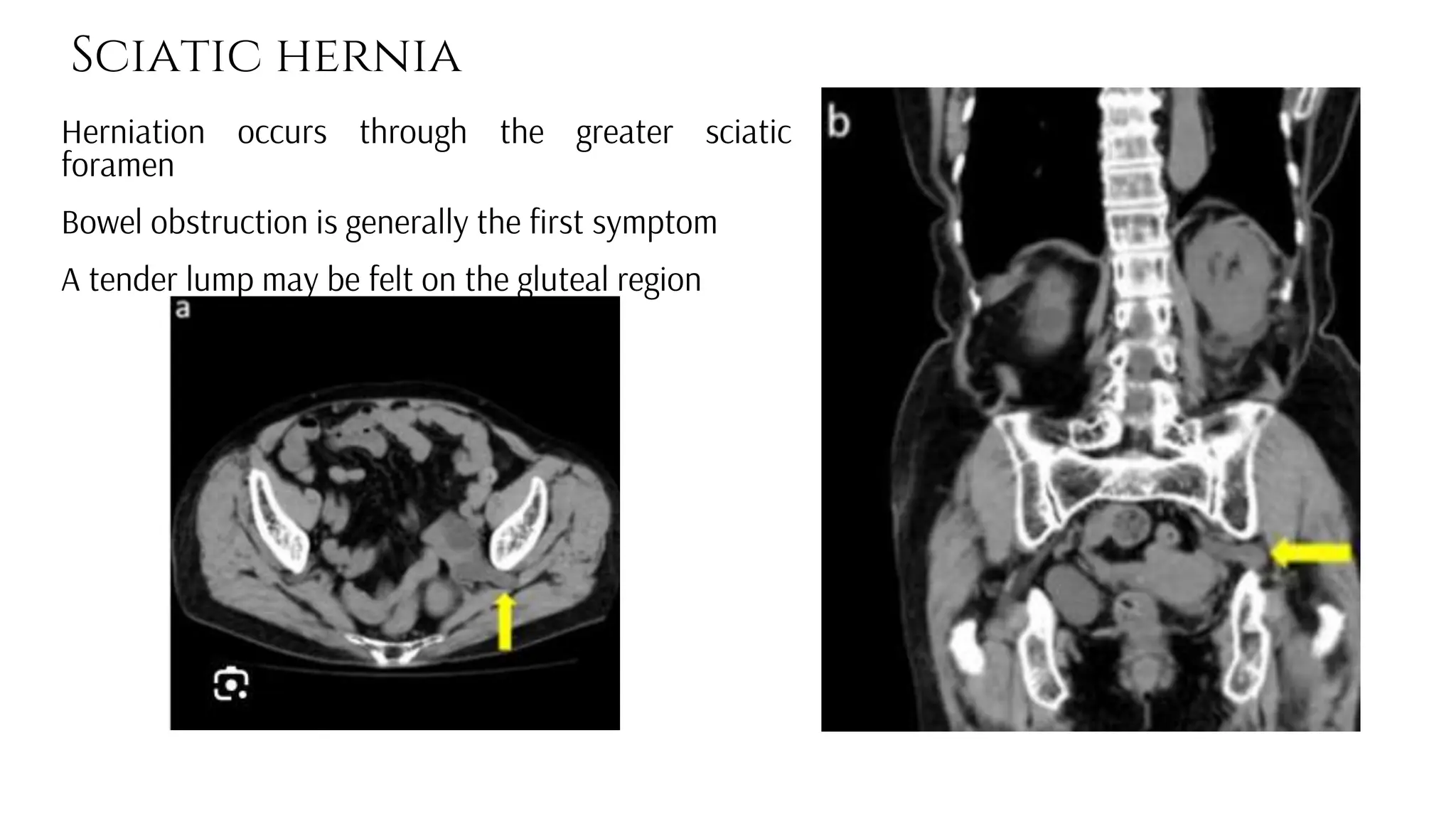 Rare Presentations of Hernias - Medical | PPTX