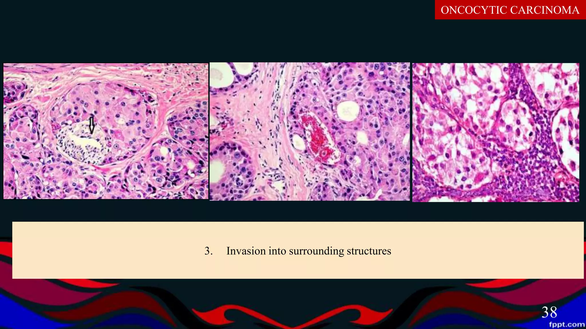Rare salivary gland lesions.ppt