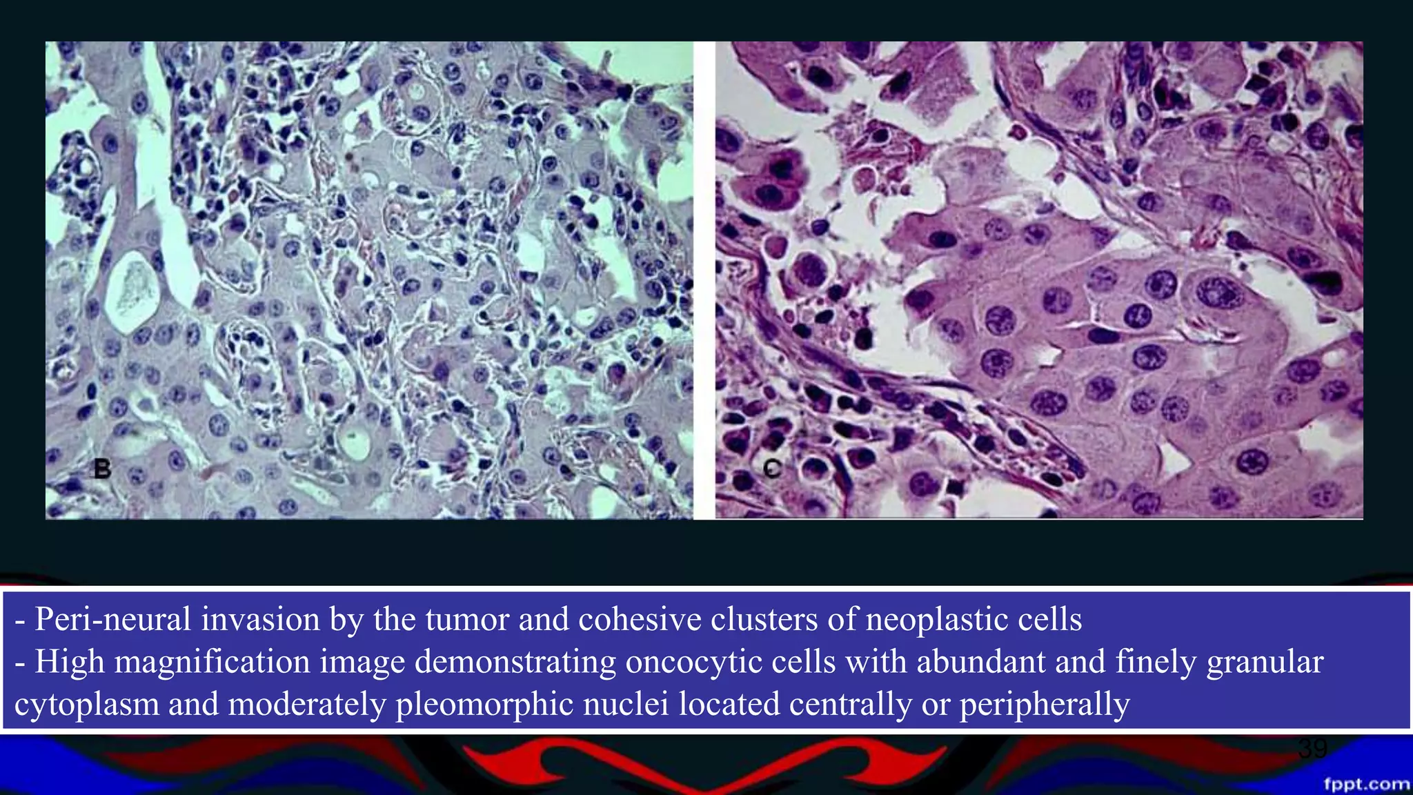 Rare salivary gland lesions.ppt