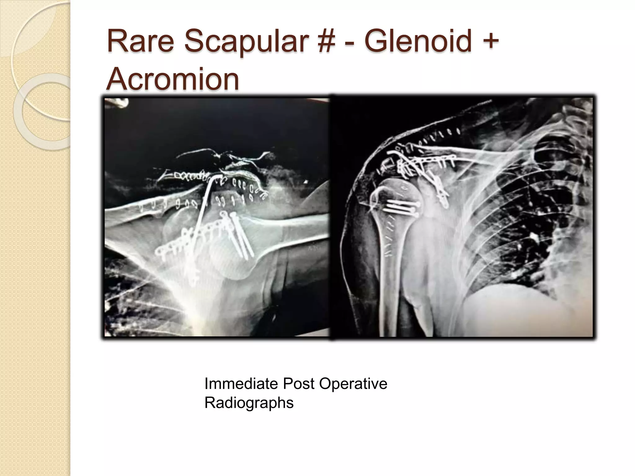 Rare scapular injuries | PPTX