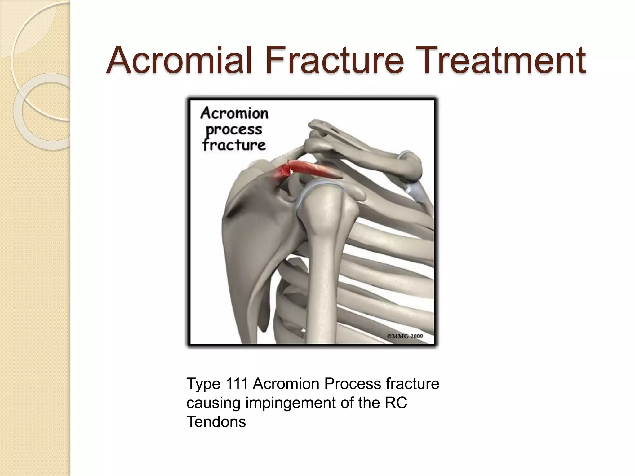 Rare scapular injuries | PPTX