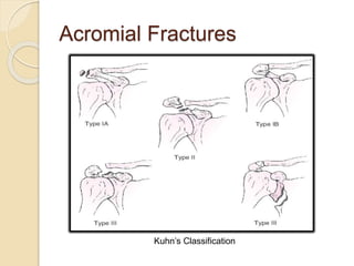 Rare scapular injuries | PPTX