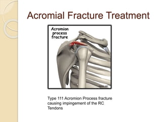 Rare scapular injuries | PPTX