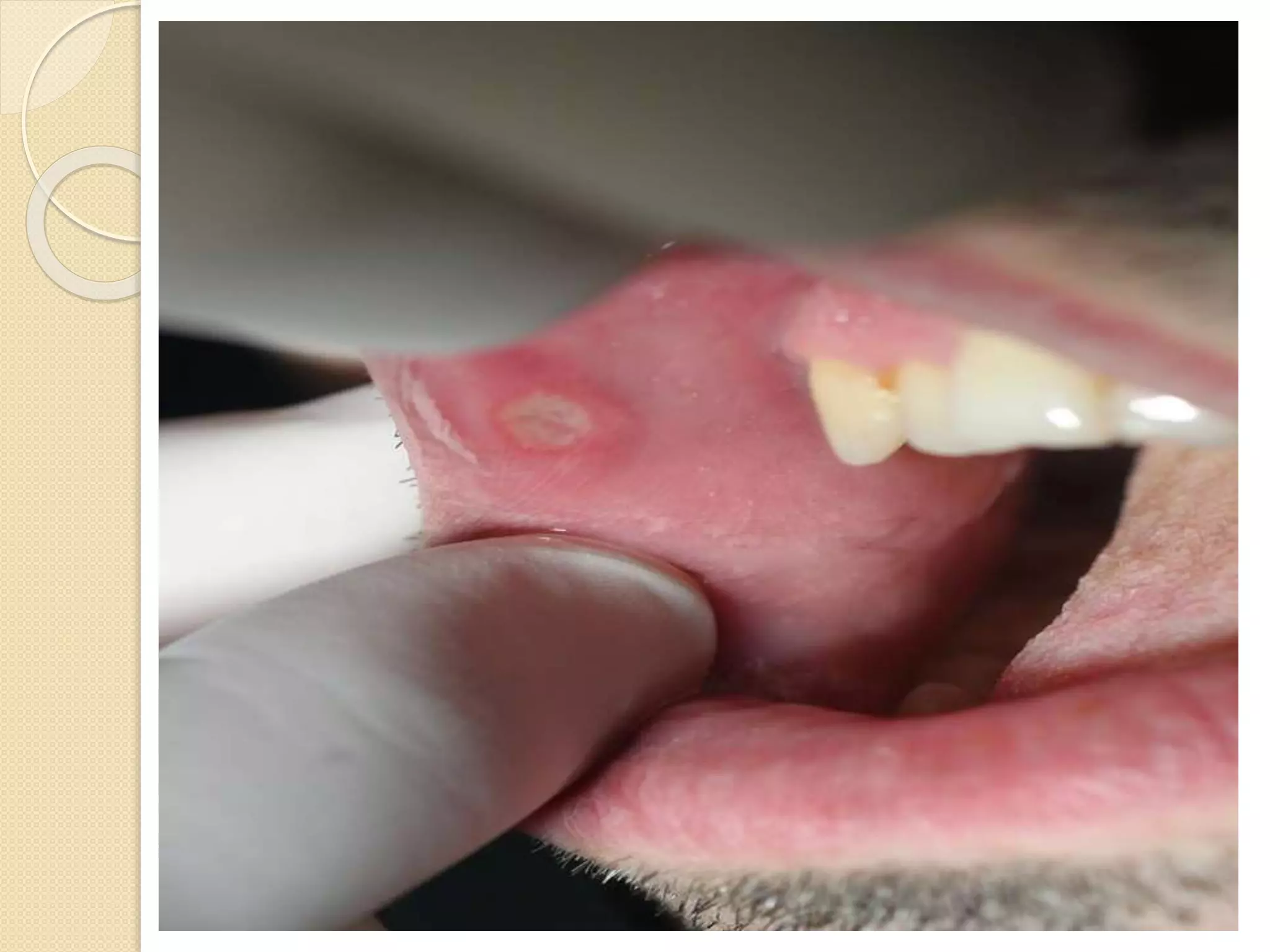 Recurrent Aphthous Stomatitis | PPTX