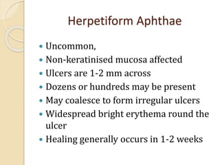 Recurrent Aphthous Stomatitis | PPTX