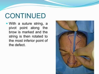 RECONSTRUCTION BY PARAMEDIAN FOREHEAD FLAP | PPTX