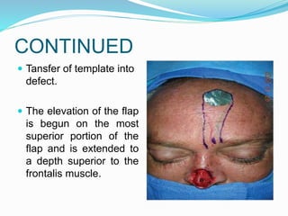 RECONSTRUCTION BY PARAMEDIAN FOREHEAD FLAP | PPTX