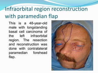 RECONSTRUCTION BY PARAMEDIAN FOREHEAD FLAP | PPTX