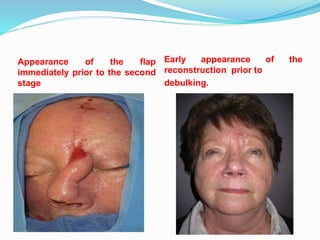 RECONSTRUCTION BY PARAMEDIAN FOREHEAD FLAP | PPTX