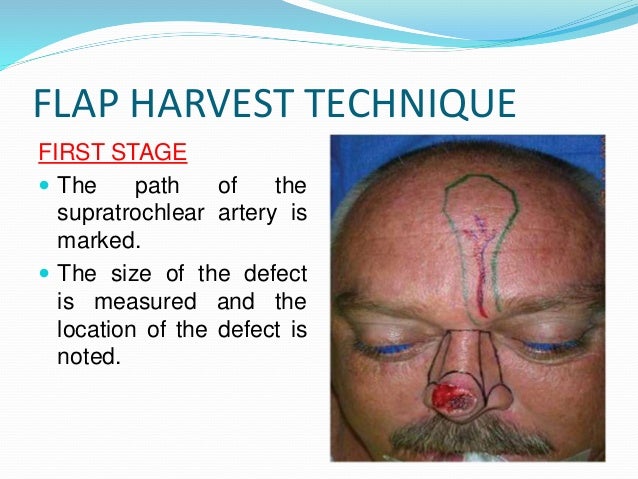 RECONSTRUCTION BY PARAMEDIAN FOREHEAD FLAP