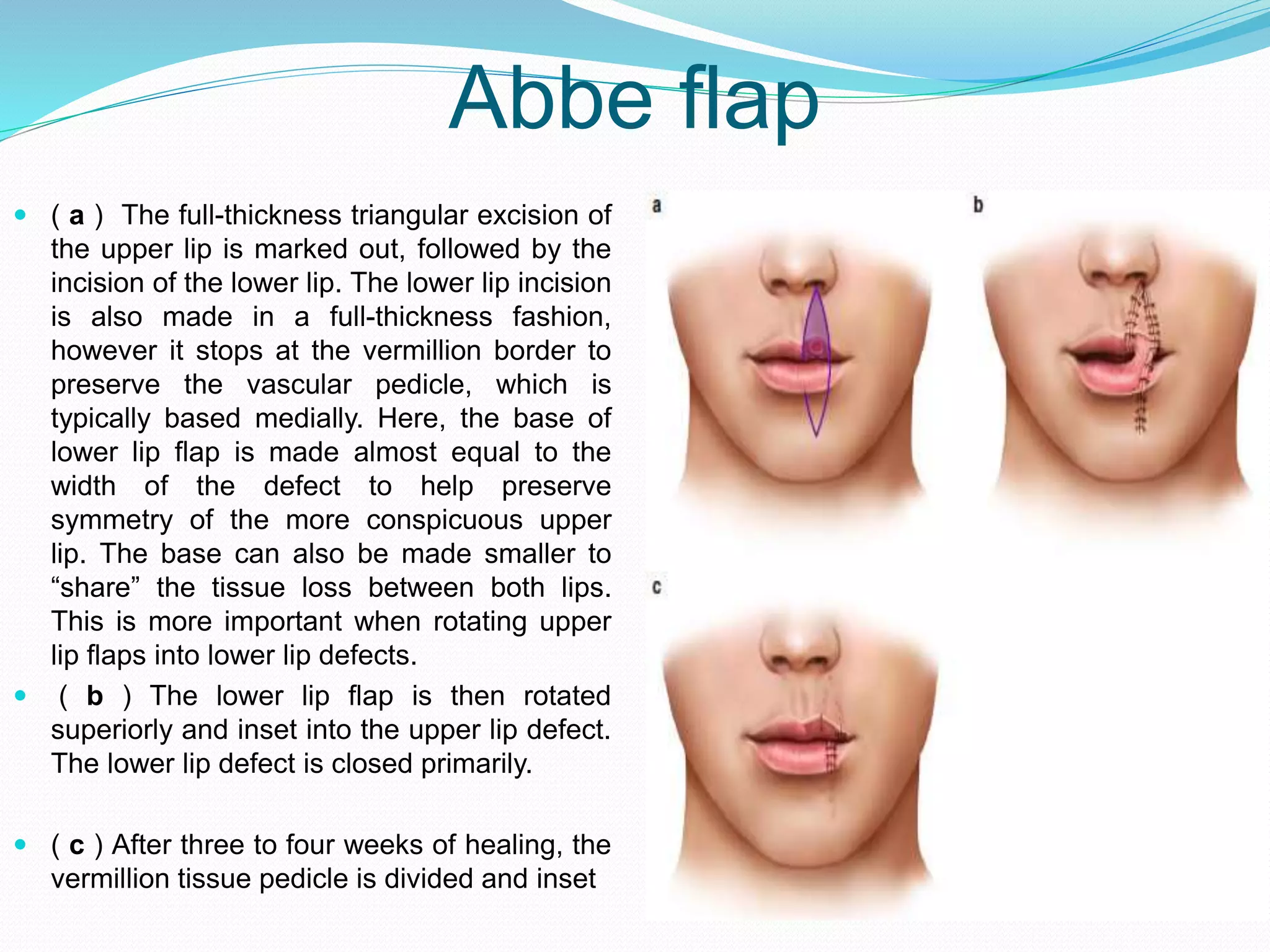 Dr. Rasel lip reconstruction cme DDCH, Dhaka, Bangladesh | PPTX