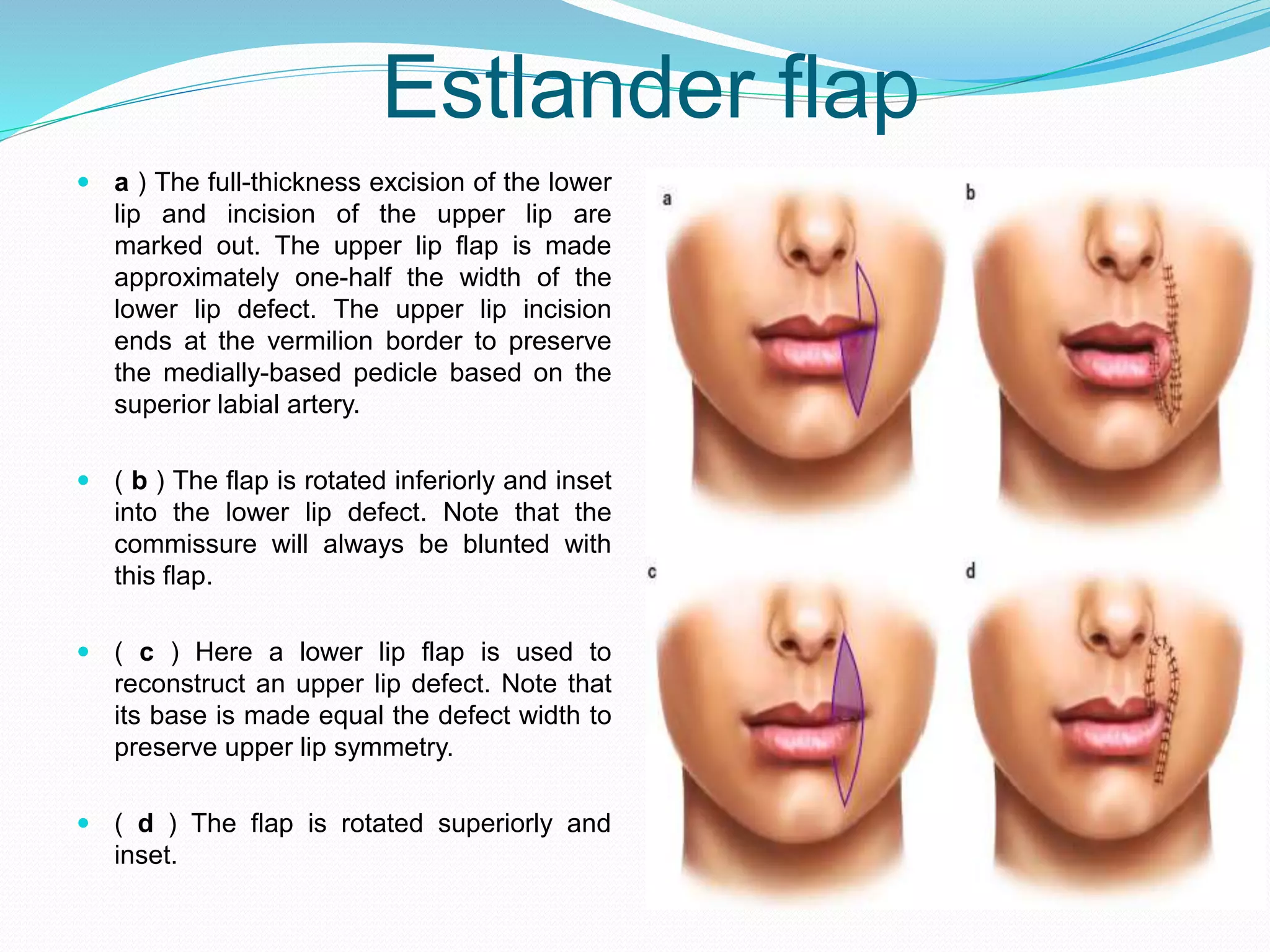 Dr. Rasel lip reconstruction cme DDCH, Dhaka, Bangladesh | PPTX