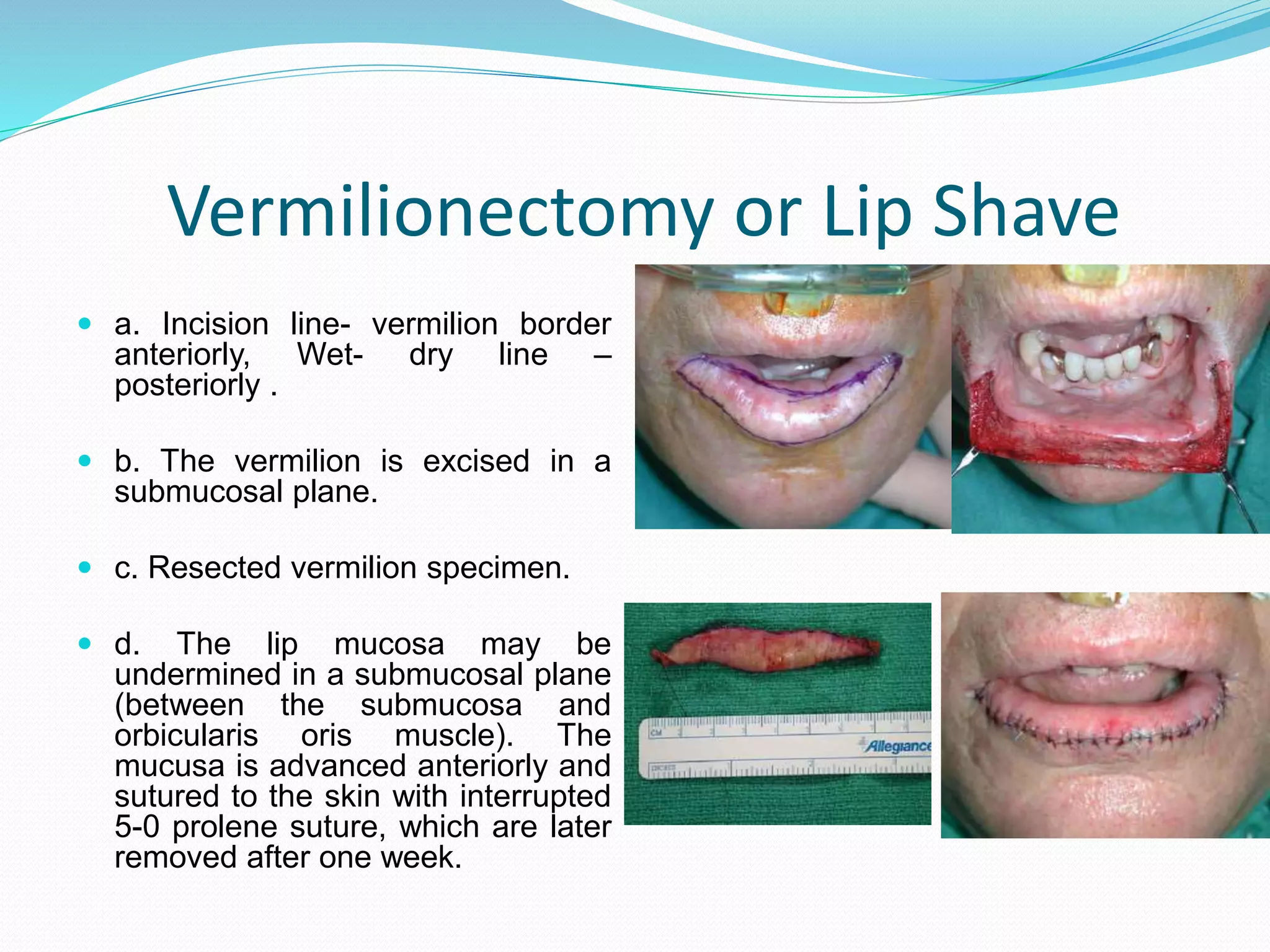 Dr. Rasel lip reconstruction cme DDCH, Dhaka, Bangladesh | PPTX