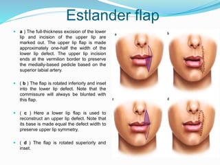 Dr. Rasel lip reconstruction cme DDCH, Dhaka, Bangladesh | PPT